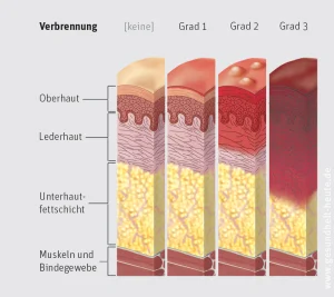 Verbrennungen Und Verbr hungen Verbrennungen Und Verbr hungen