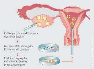 In-vitro-Fertilisation