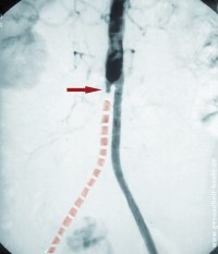 Periphere arterielle Verschlusskrankheit